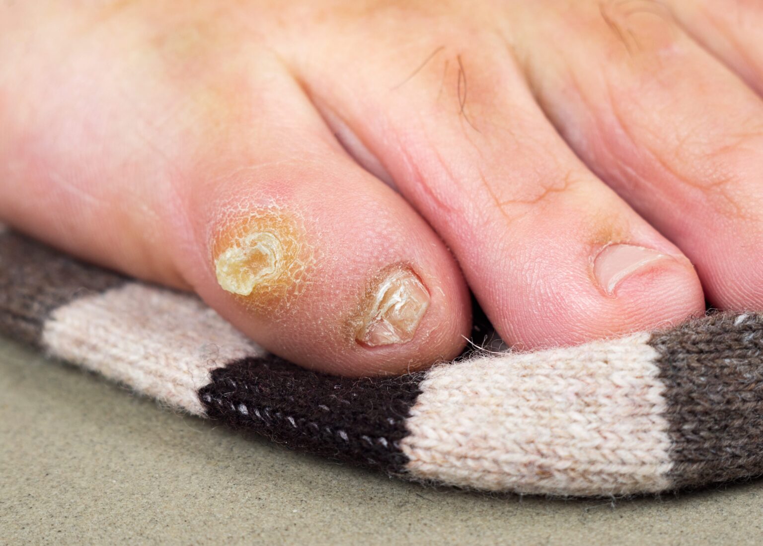 Corn Removal Surgery – Podiatry Group
